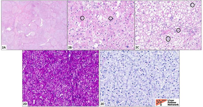 “Glycogenosis” on Liver Biopsy: Clinicopathologic Considerations | AASLD